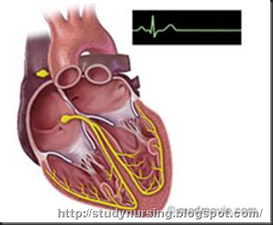 Nursing Articles: Sick sinus syndrome